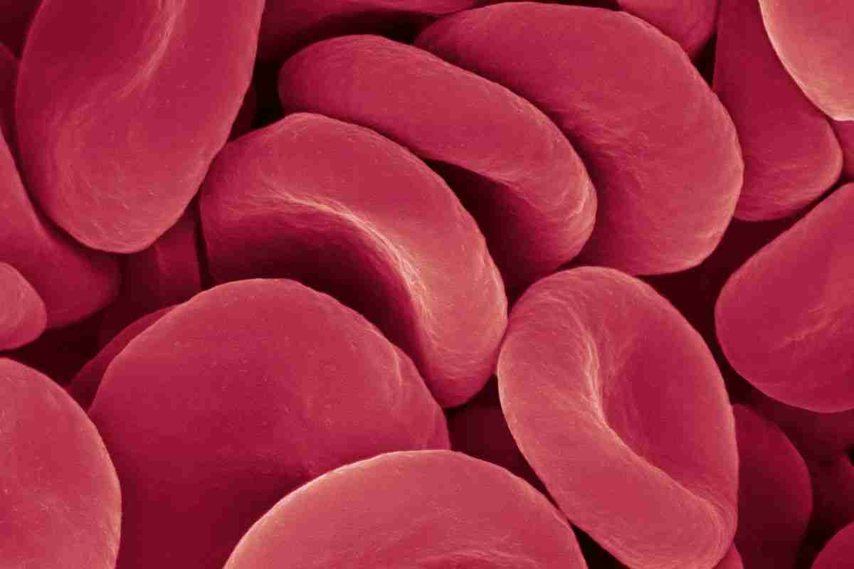 Haemoglobin C Disease: Which is worse - SC or SS genotype?