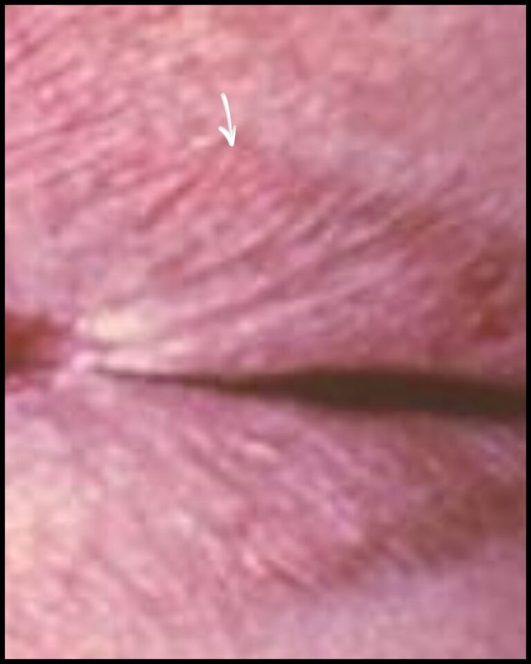 Ingrown Hair or Vaginal Cyst? A GP Explains 7 Types