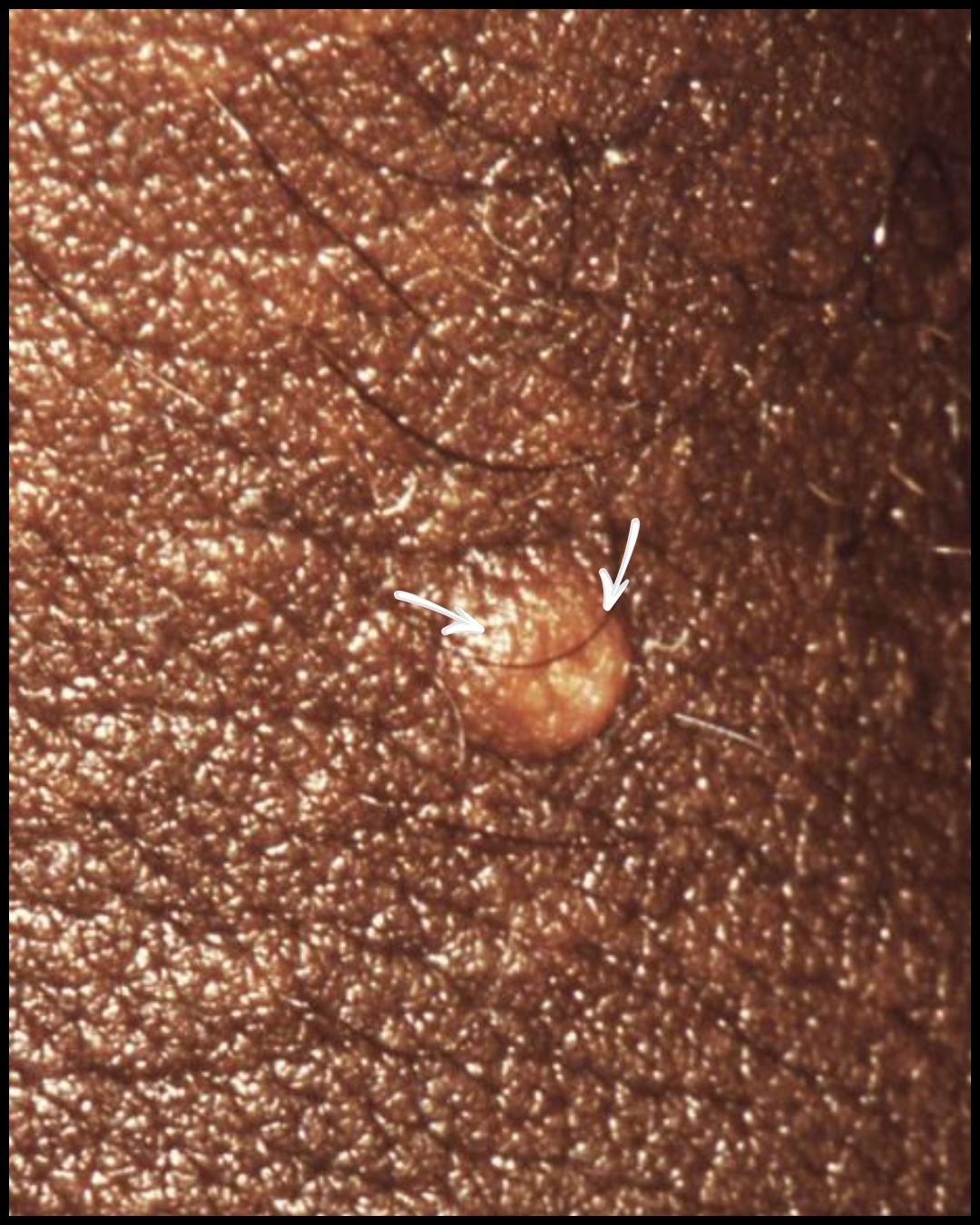 Ingrown Hair or Vaginal Cyst? A GP Explains 7 Types